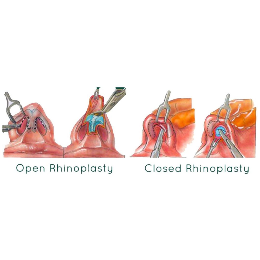 Closed vs Open Rhinoplasty - Medgol